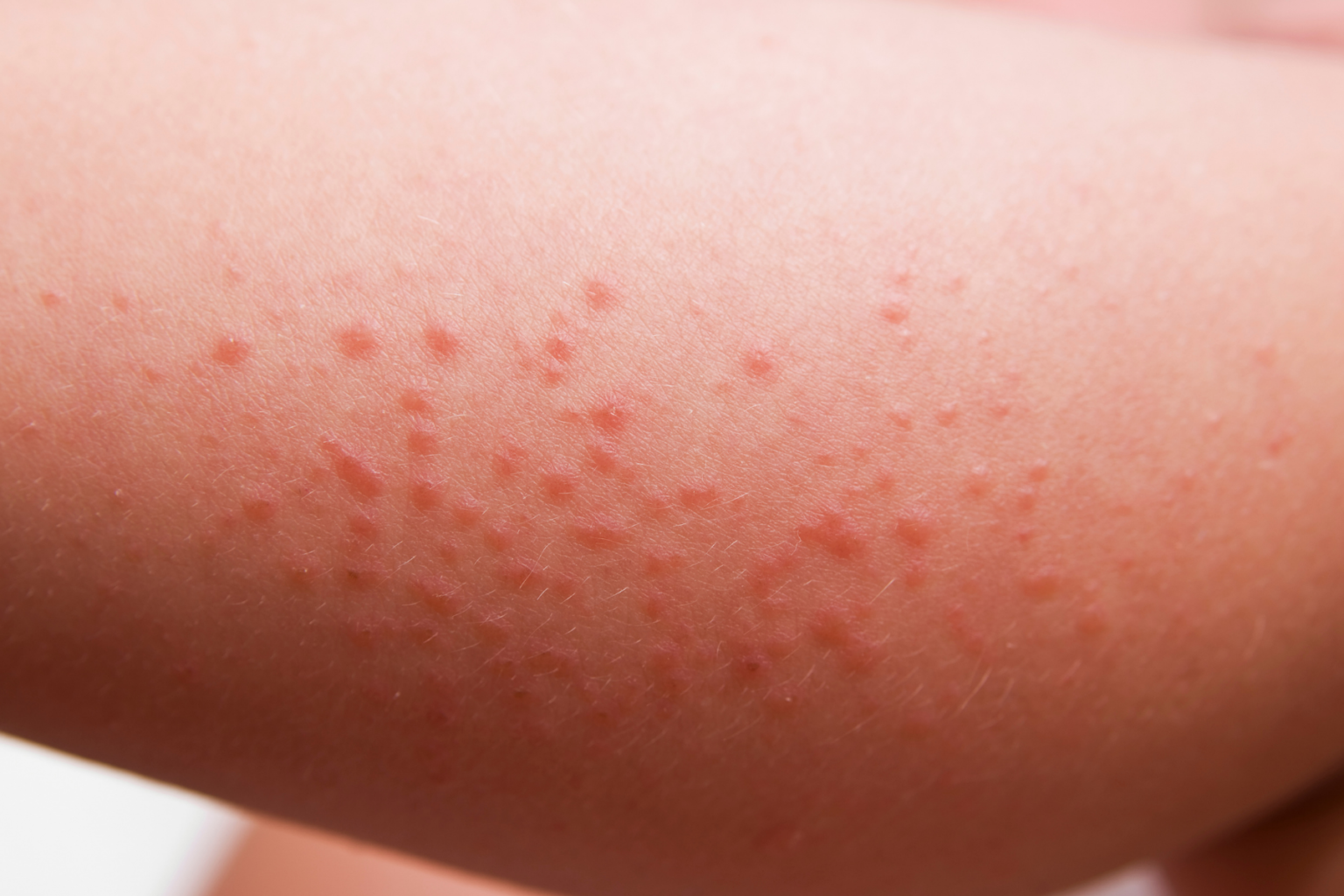 Celiac Disease Rash (Dermatitis Herpetiformis) Explained - Good For You ...