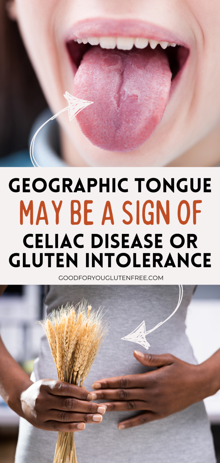 Geographic Tongue (Celiac Tongue) and the Gluten Connection - Good For ...